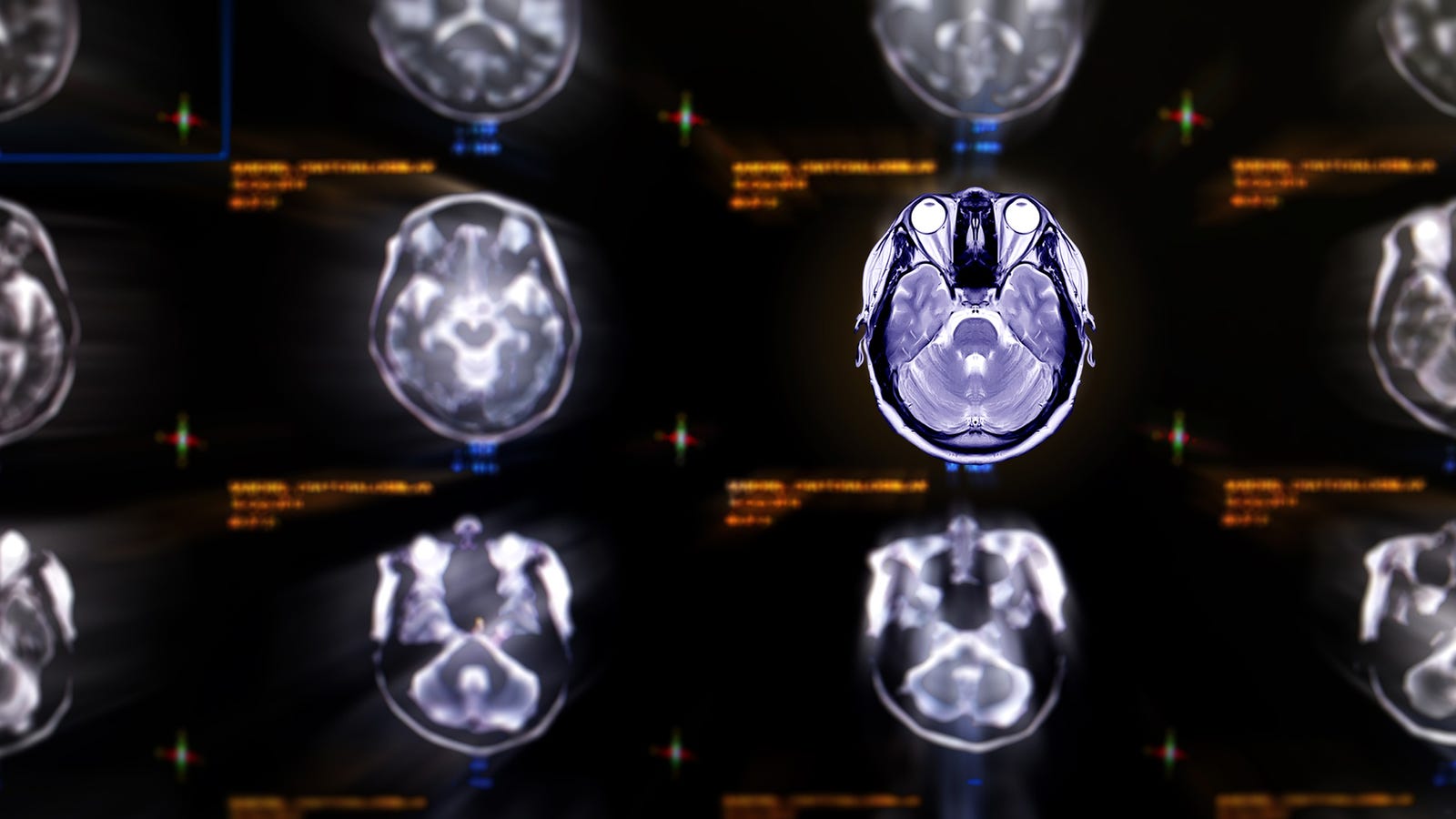 Traumatic brain injury: symptoms and complications | Sanitas magazine