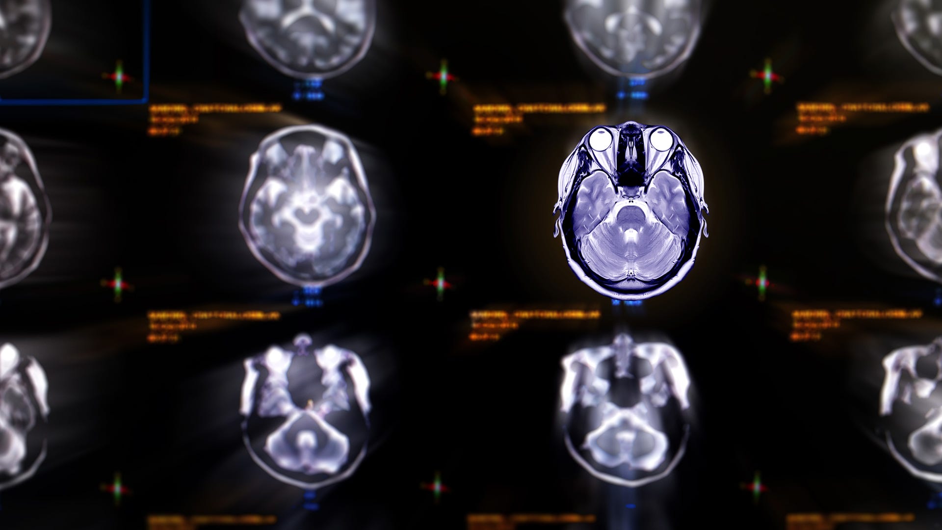 Schädel-Hirn-Trauma: Symptome und Folgen | Sanitas Magazin