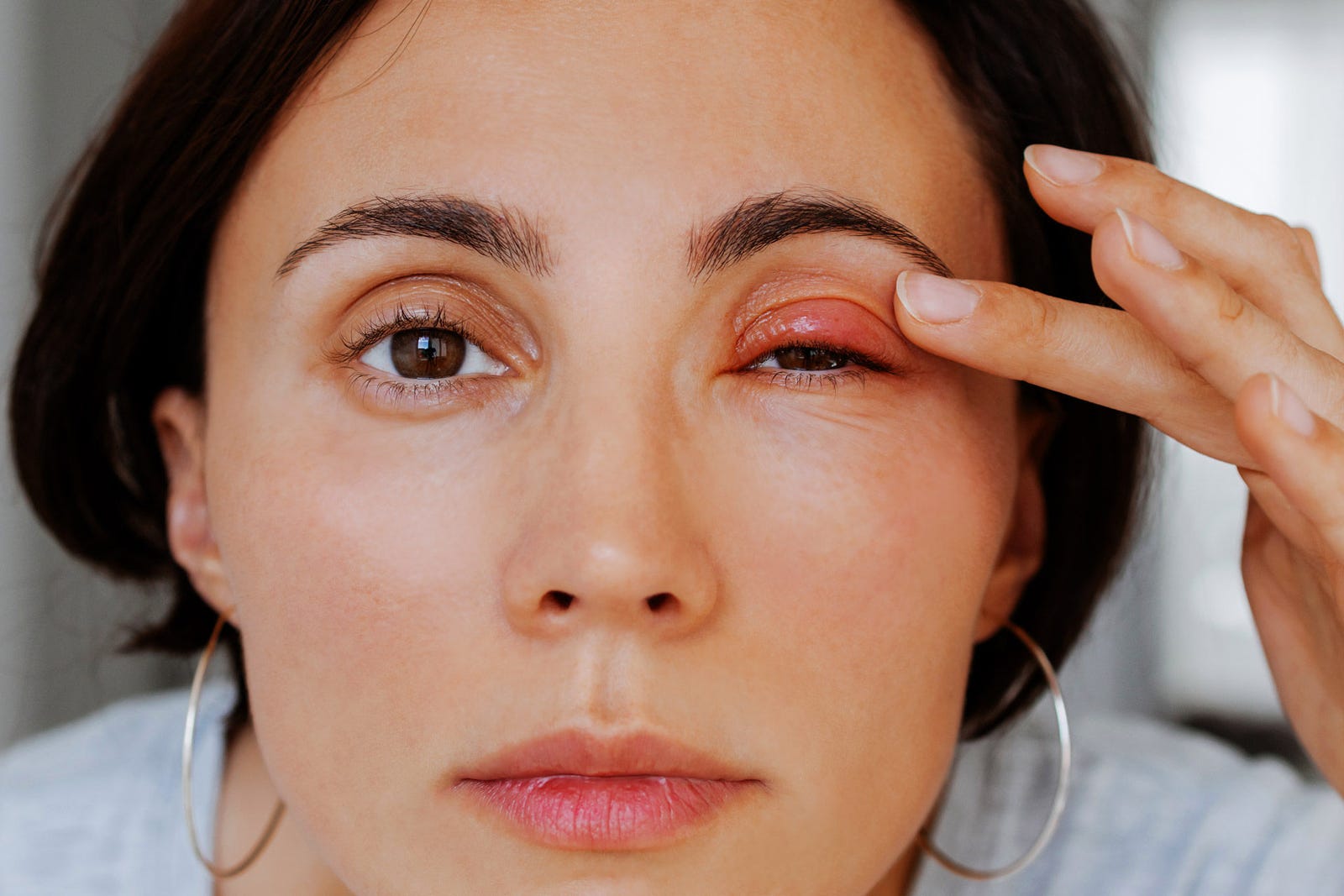 Gerstenkorn am Auge richtig behandeln | Sanitas Magazin